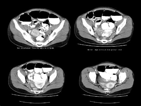 Caso Clnico Tumoracin Abdominal Dra Mayra Martel Dr