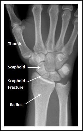 Ulnar Deviation X Ray