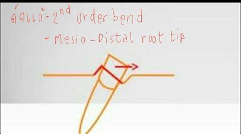 Dental Buddy ⭐ ดัดลวดแก้ Root Convergentdivergent นาน ⭐ Facebook