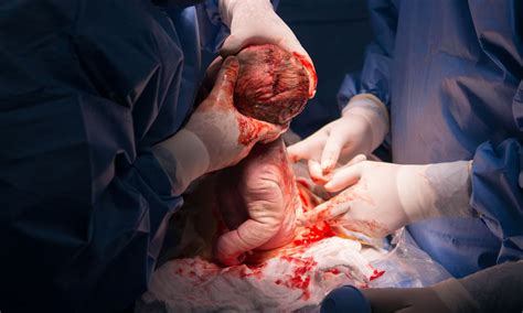 Cushing Suture Pattern China Top 3 Suture Manufacturer