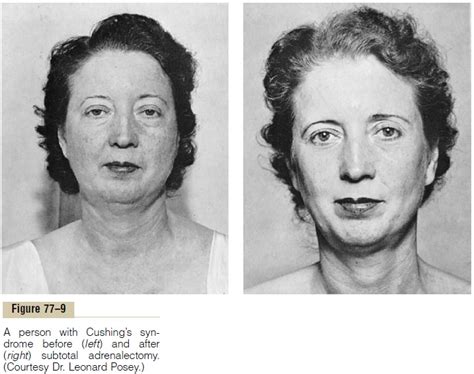 Adrenogenital Syndrome