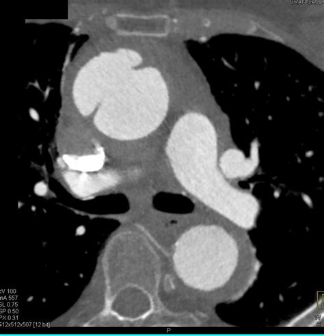 Focal Dissection Ascending Aorta Vascular Case Studies Ctisus Ct