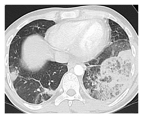 A Transthoracic Echocardiographic Apical Four Chamber View Shows A