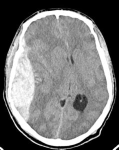 Epidural Hematoma Neuropedia