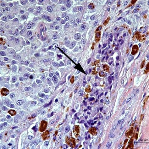 Brain A Neuronal Lipofuscinosis And Amorphous Basophilic Structures