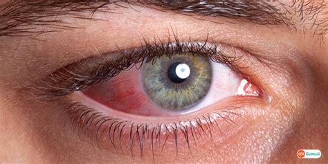 Eye Bleeding Retina At Lisa Hawke Blog