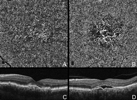 Difference In Vessel Density Between Nonexudative And Active Choroidal Download Scientific