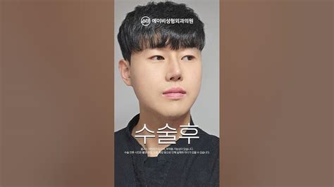 남자눈매교정남자코성형윤곽3종 후기 Shorts Youtube