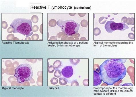 Reactive Lymphocytes Vs Monocytes