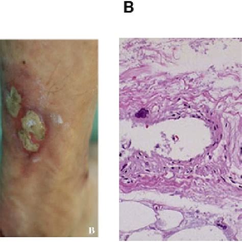 Representative Pictures Showing Skin Ulcer And Calcification In The Download Scientific Diagram