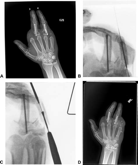 Removal Of Misplaced Intramedullary Nails For Proximal Phalanx And Metacarpal Fixation Journal