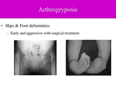 Ppt Arthrogryposis And Amyoplasia Powerpoint Presentation Id839019