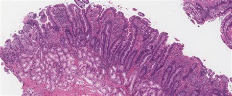 Bệnh Celiac Mypathologyreportca