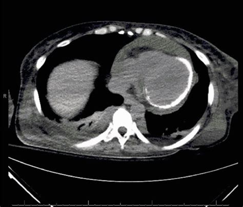 Figure 1 From A Case Of Left Ventricular Myocardial Calcification In A
