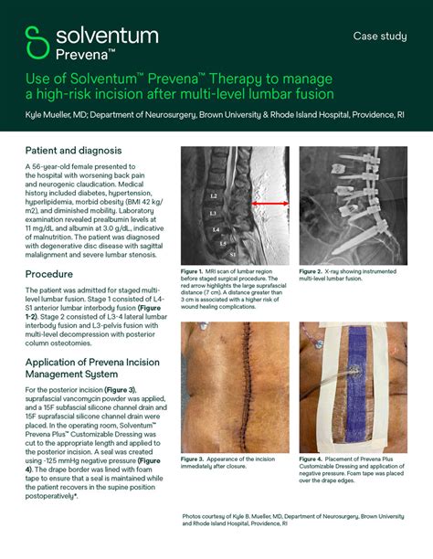 3m Prevena 治療用於脊椎手術 Solventum