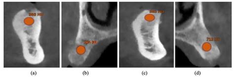 Post Operative Cone Beam Computed Tomography Cbct After 6 Months To Download Scientific