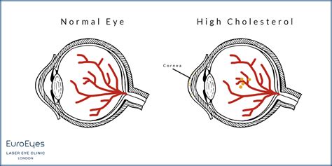 What Illness Can An Eye Test Detect Euroeyes