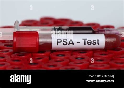 Psa Test To Look For Abnormalities From Blood Blood Sample To Analyze