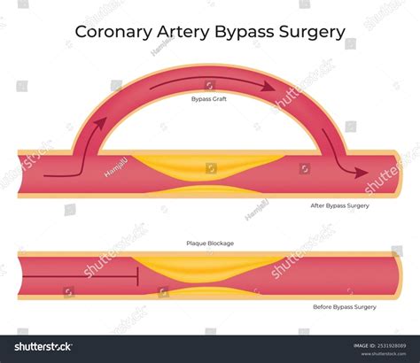 Coronary Artery Bypass Surgery Science Design Stock Vector Royalty