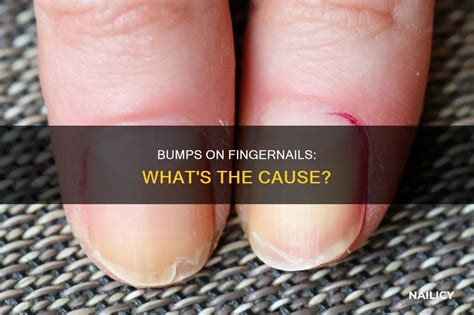 Bumps On Fingernails Whats The Cause Nailicy