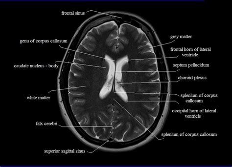 Labeled Mri Brain Anatomy At Lynn Craig Blog
