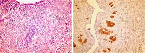 A Practical Approach To The Diagnosis Of Mixed Epithelial And