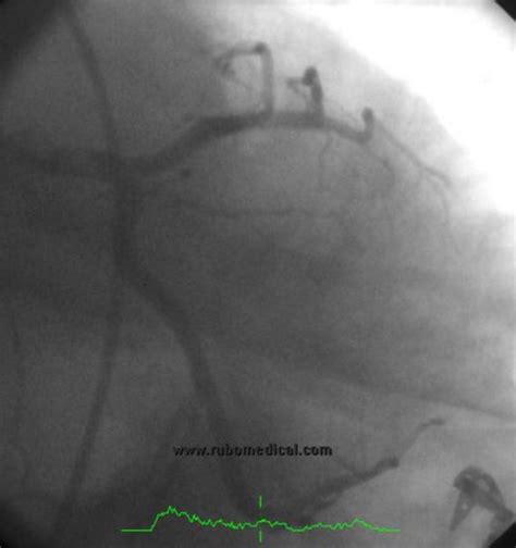 Stemi Patient With Large Thrombus In Lm Treated With Full Dose