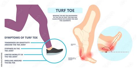 Turf Toe Symptoms And Treatment Paul Miller Podiatry