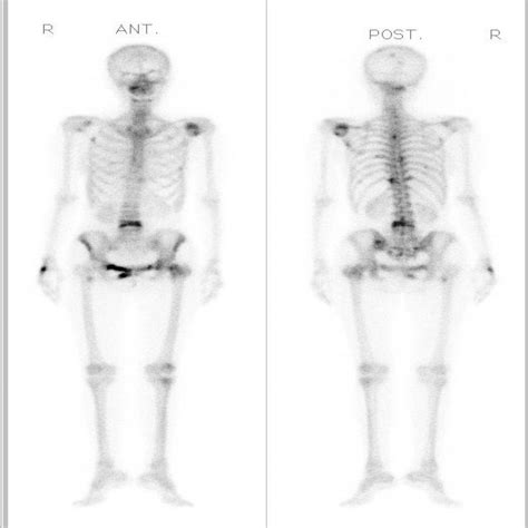 Bonetumer Object Detection Model By University