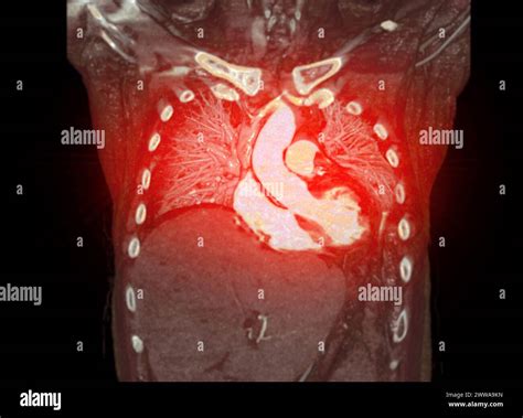 Cta Thoracic Aorta 3d Rendering Offers Detailed Visualization Providing Clear Insights Into