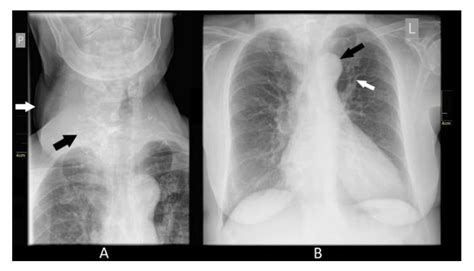 Effective Preoperative Plasmapheresis Treatment Of Severe