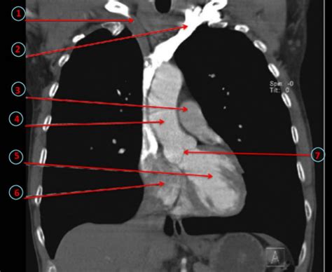 Coronal Ct 1 Diagram Quizlet