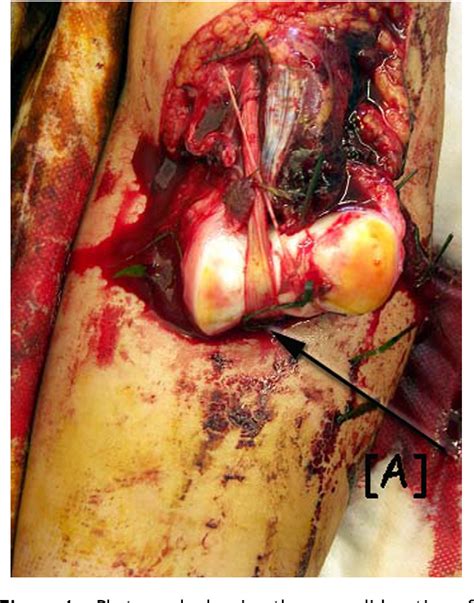 Figure 1 From Open Postero Medial Dislocation Of The Elbow In A 11 Year Old A Case Report