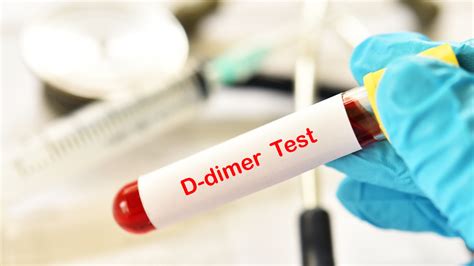 Xét Nghiệm D Dimer Dùng Trong Chẩn đoán Bệnh Gì Trung Tâm Tiêm Chủng