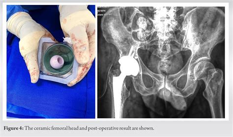 Intra Articular Osteochondroma Of The Hip Total Hip Replacement After Tumor Resection In A