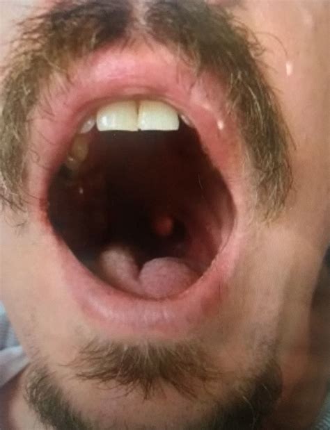 Uvula Deviation