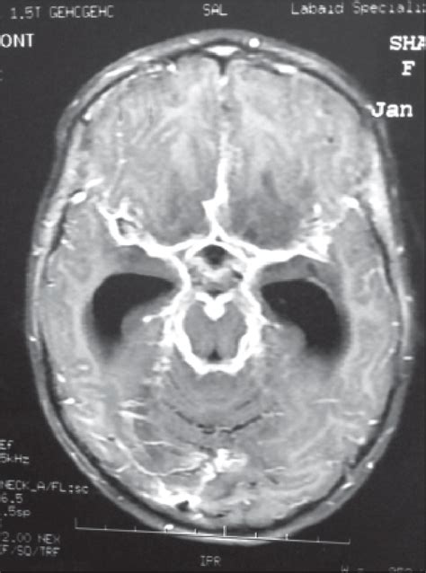 Mri Of Brain Showing Basal Cistern Enhancement I On Contrast Enhanced