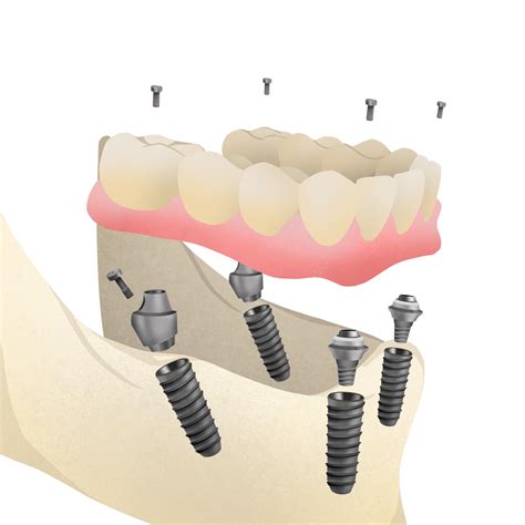 Medvine Dental Thailand Added A Medvine Dental Thailand