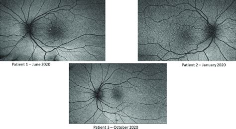 Patient 1 Yellowish Hue Within The Macula With Loss Of Fovea Reflex