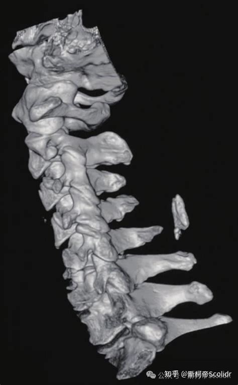 项韧带钙化与颈椎病有关吗？ 知乎