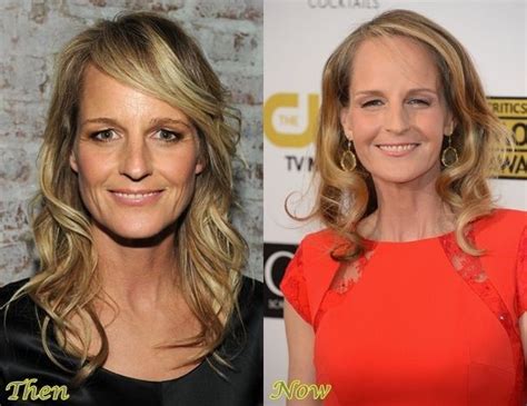 Helen Hunt Bad And Good Plastic Surgery