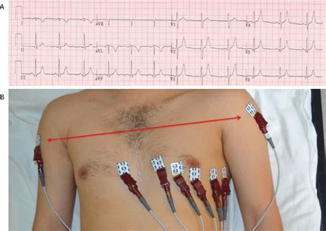 View Of Common Ecg Lead Placement Errors Part I Limb Lead Reversals