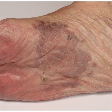 Patch Stage Ks With Promontory Sign Dilated Irregular Vascular