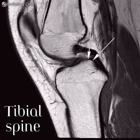 Correct Answer Tibial Spine Share This Post In Your Story Question