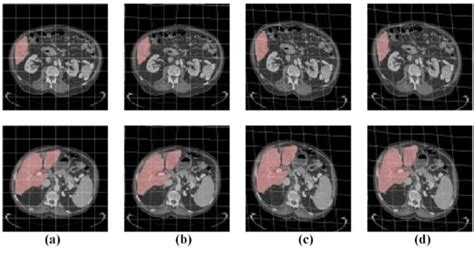 Illustration Of 3d Dataset Augmentation A Original Ct B Elastic Download Scientific Diagram