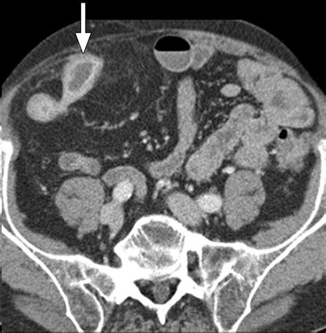 A Pattern Approach To The Abnormal Small Bowel Observations At Mdct