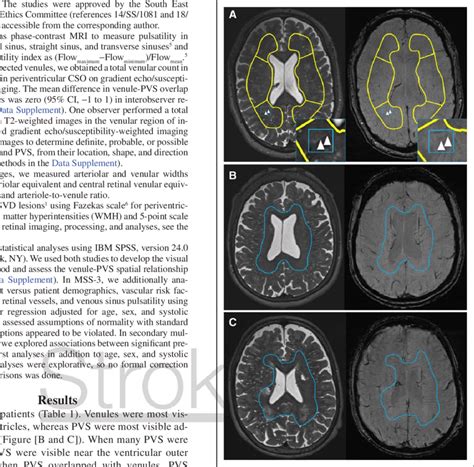 Figure Examples Of Venules Related To Perivascular Spaces Pvs A