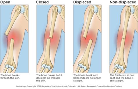 Exam 3 Musculoskeletal Flashcards Quizlet