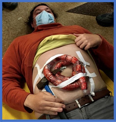 Abdominal Trauma Update Evisceration Management