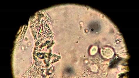Trichomoniasis Pictures Under Microscope